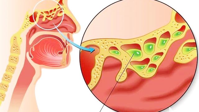 鼻窦炎手术有哪些?医生一次说全!