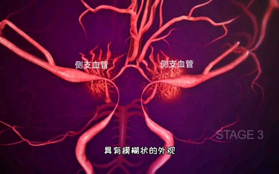 脑血管也可以做搭桥手术,烟雾病的发病原因和治疗,3D演示。
