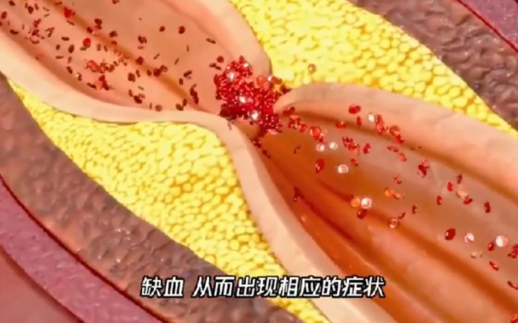 出现这9个症状,别大意!可能是动脉粥样硬化!