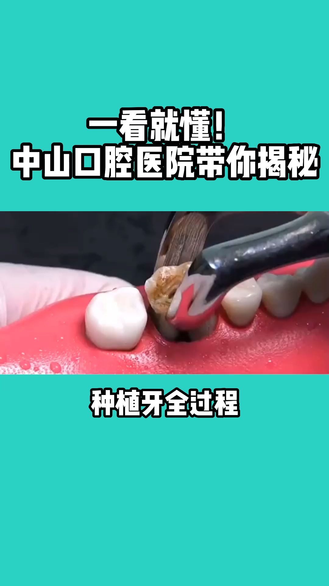 一看就懂!中山口腔医院带你揭秘种植牙全过程