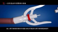 飞锐free包皮自动环切吻合器