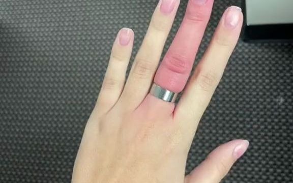 妹子戴着的戒指取不下来了,家人、消防员、医生轮流出动,最后终于...