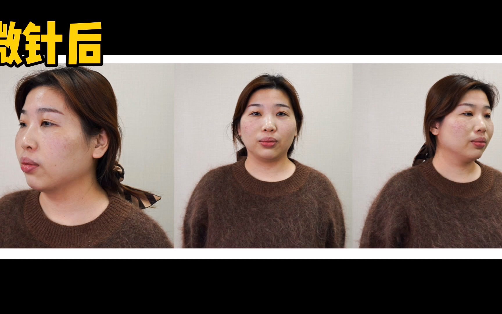 ߒ�真人手把手教你微针,微针实操来啦(含前后对比图)