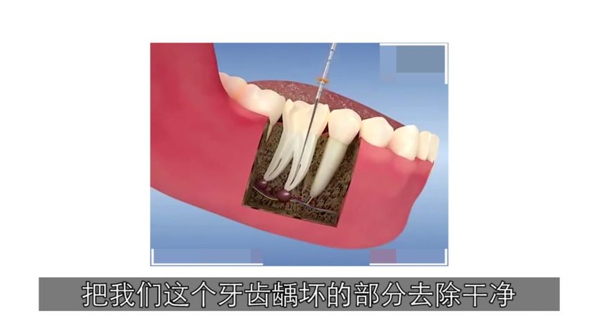 原来根管治疗的流程是这样的