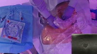 超声引导颈内静脉穿刺置管演示 2018 Ultrasound Guided Central Line ...