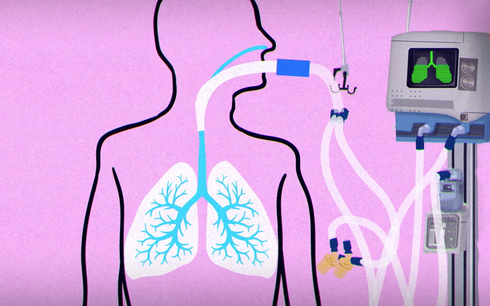 呼吸机是如何工作的?