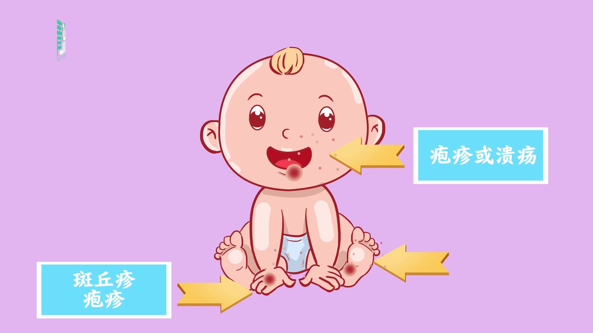 【动画】夏季诺如病毒、手足口病等传染病高发 如何避免中招?