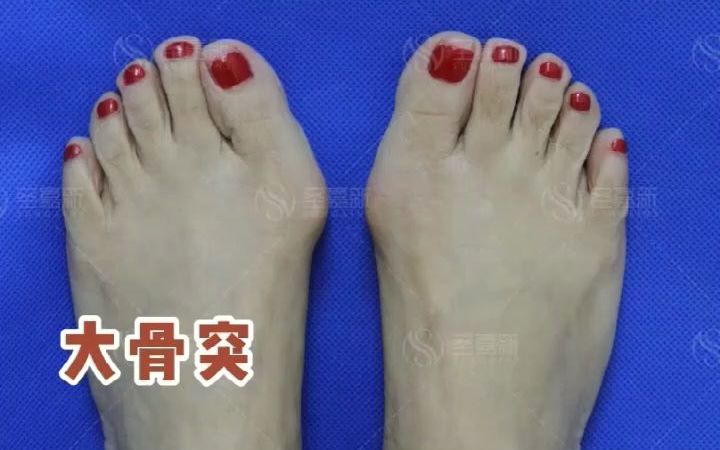 苏敬达大脚骨|难看的拇外翻,做手术3个月了