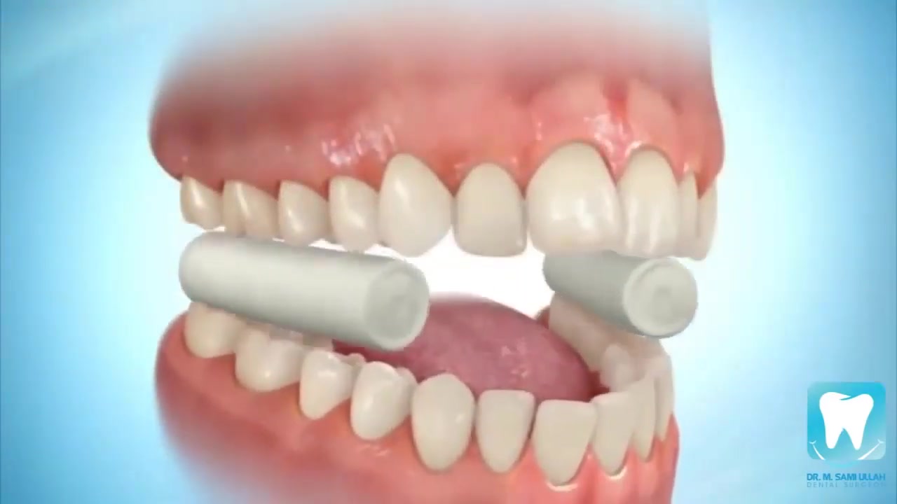 都听我的好好看看,视频动画还原牙齿正畸矫治的过程