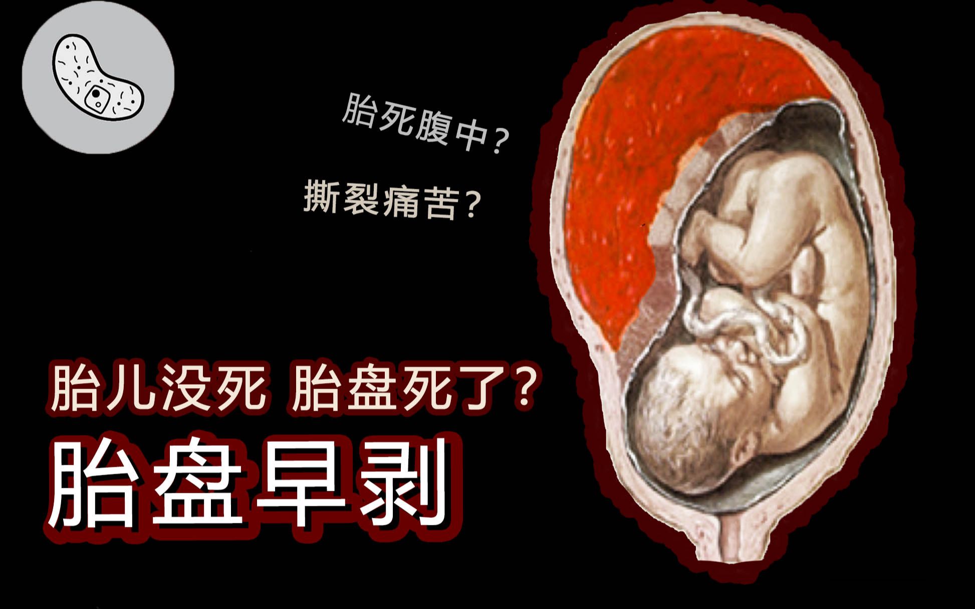 【胎盘早剥】胎儿没死 胎盘先死了会怎样?临盆降至 胎死腹中?【灰...