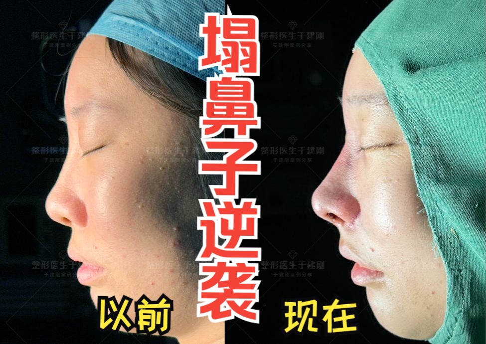 塌鼻梁从无到有,逆袭骨相美女颜值upup!#鼻整形于建刚
