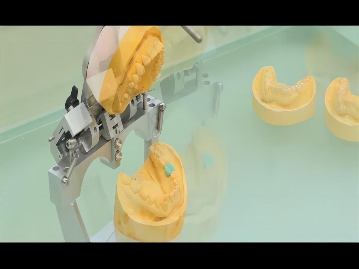 前牙美学区的引导骨再生方案