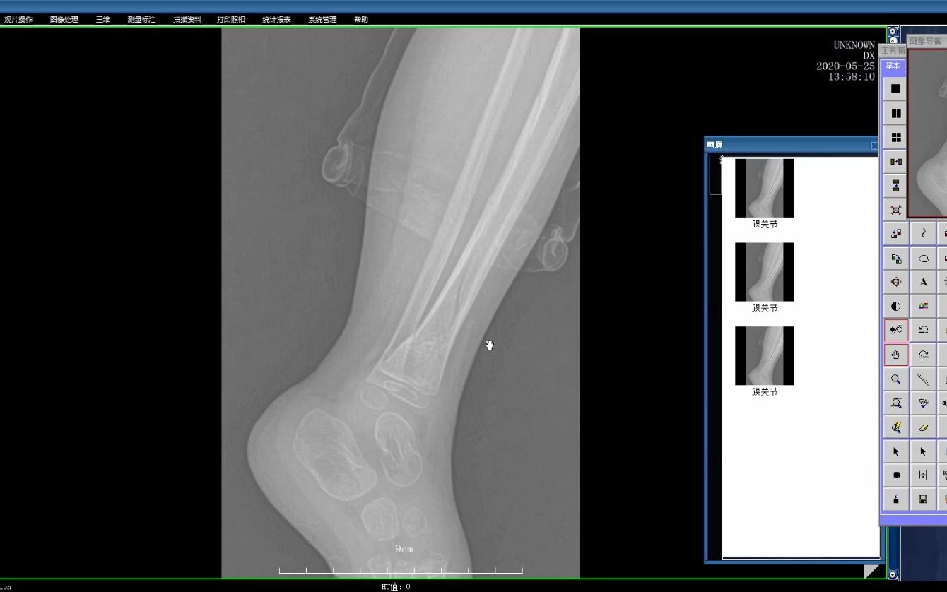 医院影像科PACS系统源码带三维重建源码