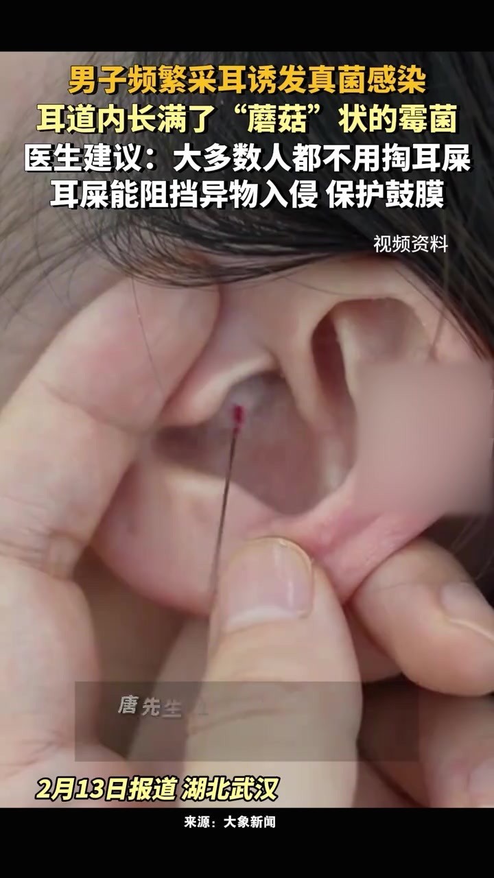 男子频繁采耳诱发真菌感染,耳道内长满了“蘑菇”状霉菌,医生:大多数...