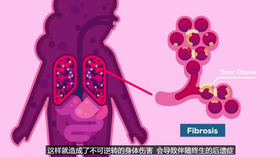 什么是新冠肺炎?这里有你想了解的一切