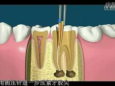 牙痛去医院是,医生是这样给你看病的:根管治疗过程