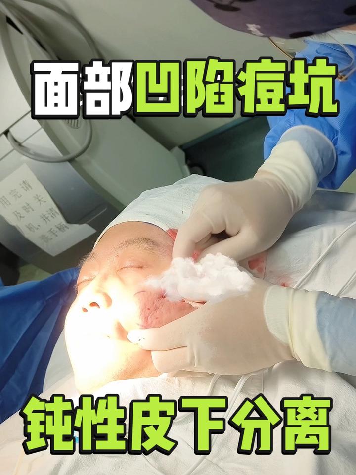 面部大面积凹陷痘坑的钝性皮下分离#痘坑修复中 #手术室日常 #医学...