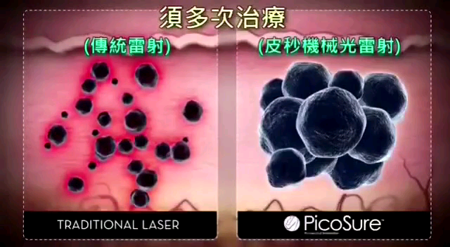 美国赛诺秀755蜂巢皮秒VS传统激光