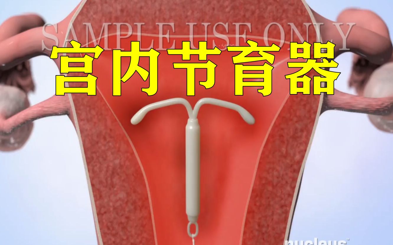 【3D医学动画】宫内节育器