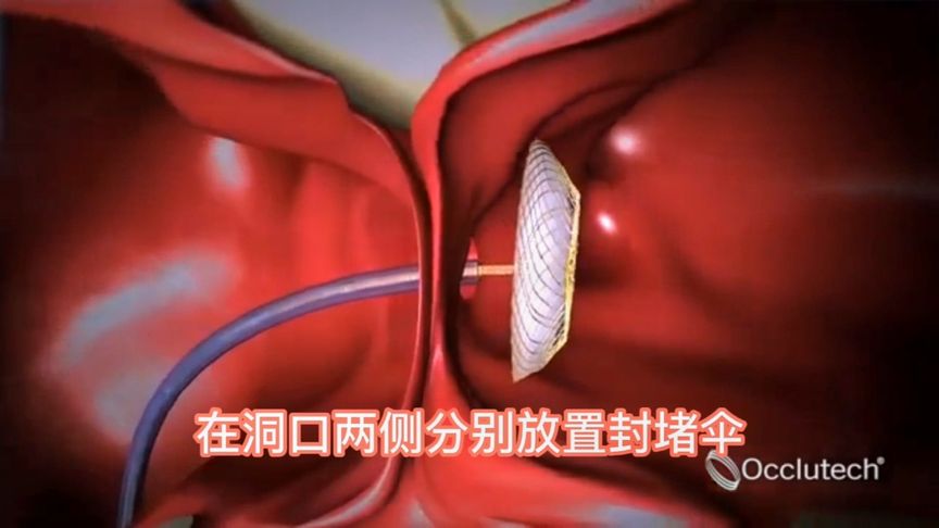 血管外科医生通过一根导管就能治疗先天性心脏病,前方高能!