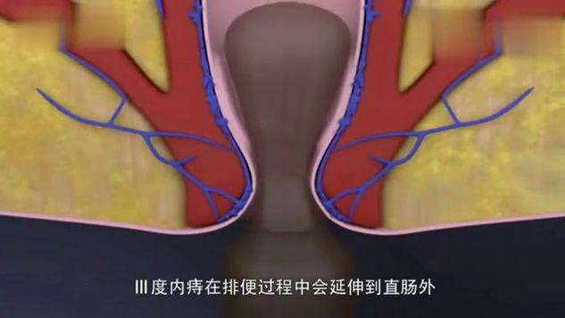 原来痔疮切是这样产生的,终于明白了!