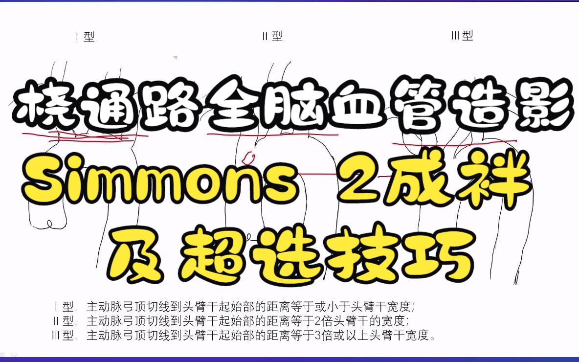 经桡通路全脑血管造影Simmons 2成袢及超选技巧