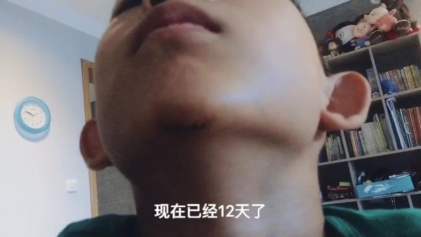 下巴用美容线缝针,当时医生说不用拆线,最后为啥又选择了去拆线