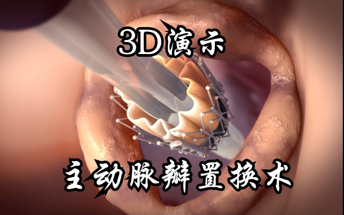 3D演示:主动脉瓣置换术