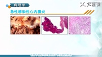 ...心血管系统疾病 第四节 感染性心内膜炎 1.感染性心内膜炎 病理变化...