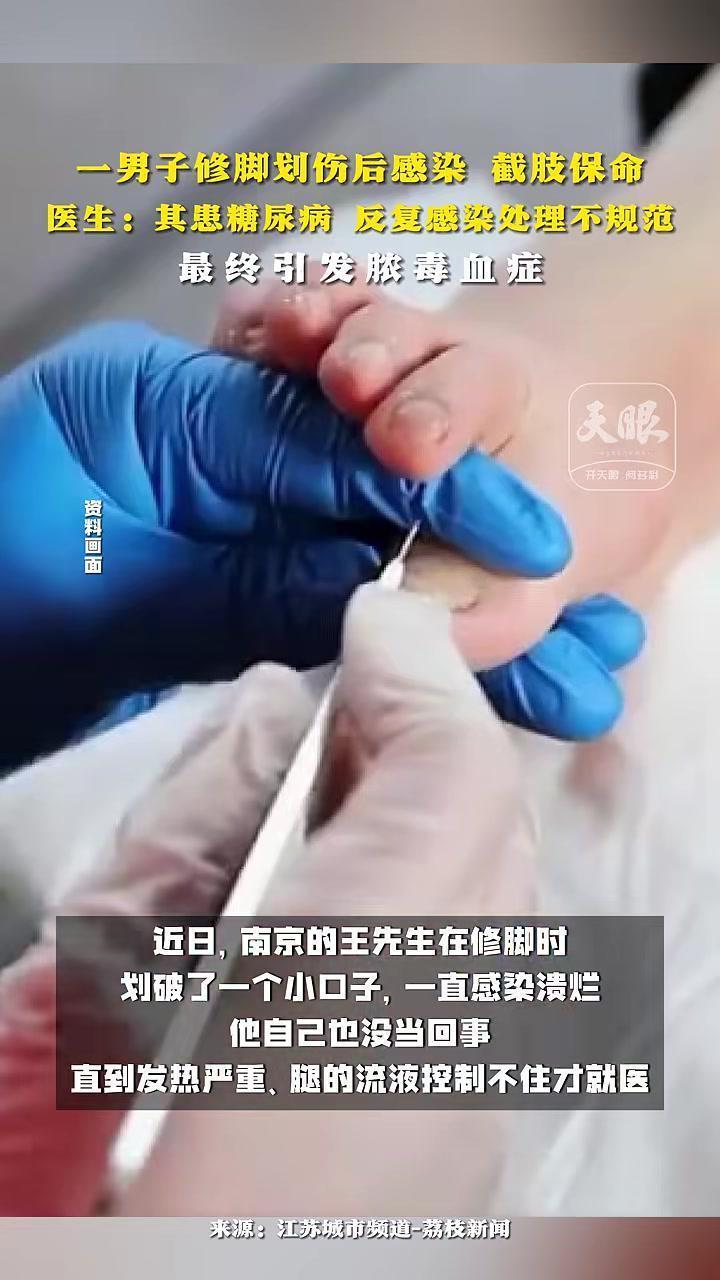 ...处理不规范最终引发脓毒血症(来源:江苏城市频道-荔枝新闻制作:彭瑾)