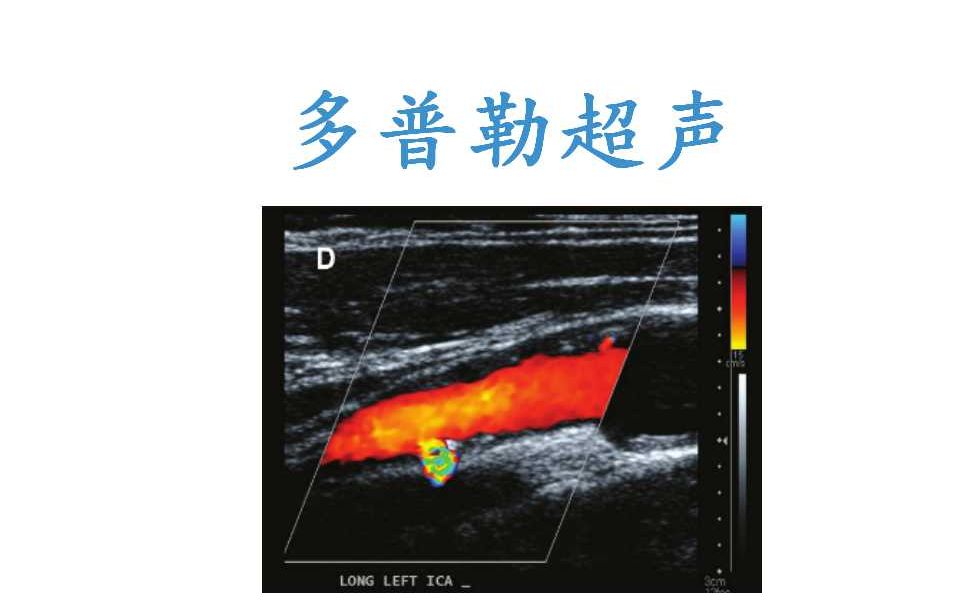 字幕版【医学成像100】29. 多普勒超声(彩超)*美国医学物理师*西安...