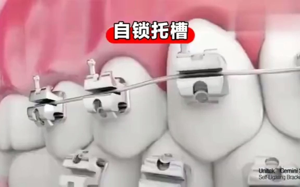 北京圣贝吕医生告诉你:自锁牙套的闭锁装置!