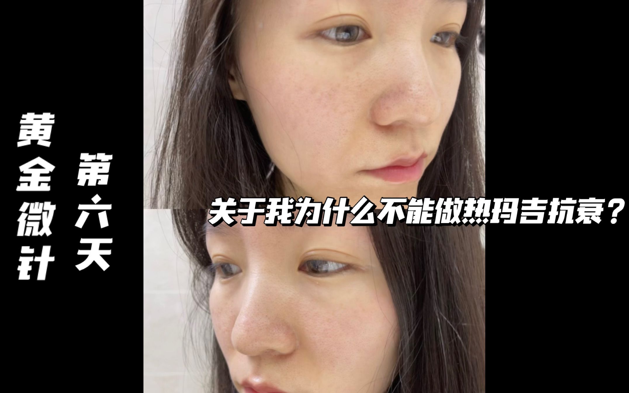 黄金微针第六天记录:关于凹陷脸为什么不能选择热玛吉抗衰?