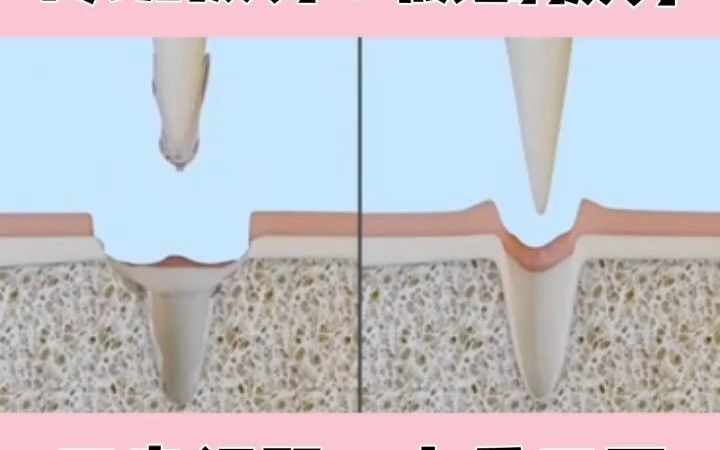 传统拔牙VS微创拔牙,你是哪一种?