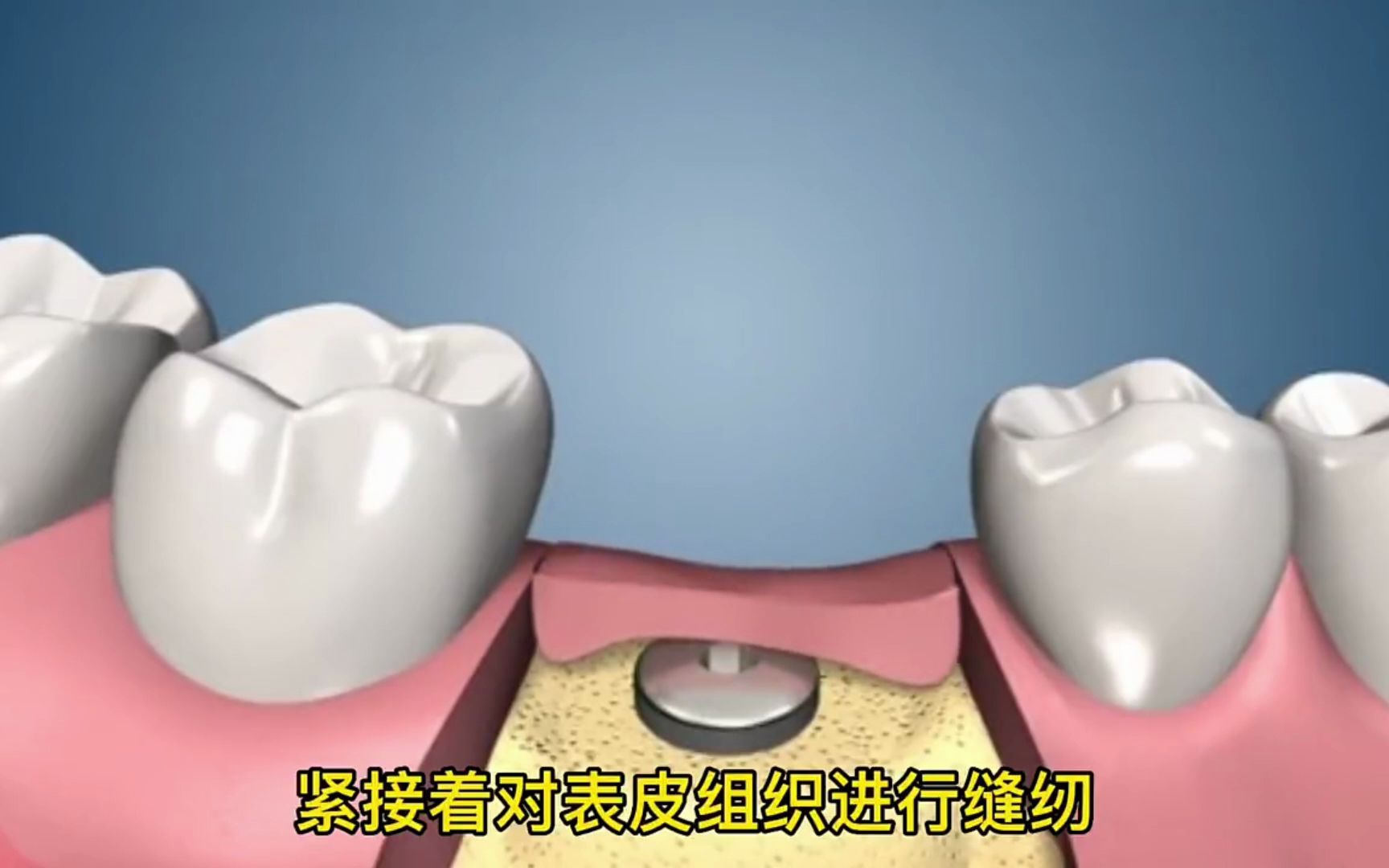 带你一探种植牙全过程,看完在也不用害怕去种牙啦!