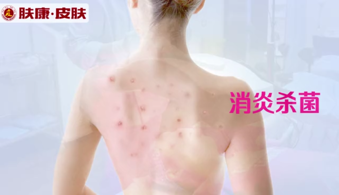 【深圳正规皮肤病专科】夏天是毛囊炎好发的