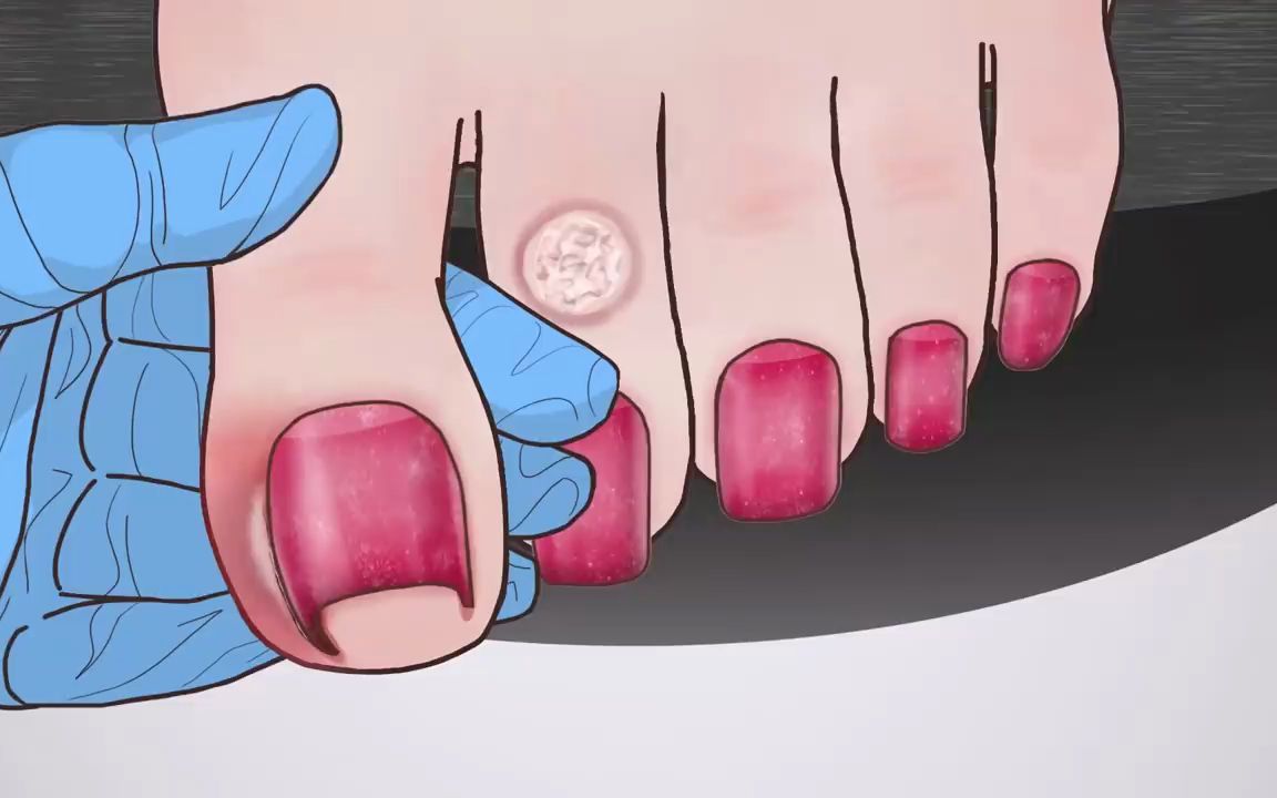 【沉浸式修脚】向内生长的脚趾甲和甲沟炎治疗动画