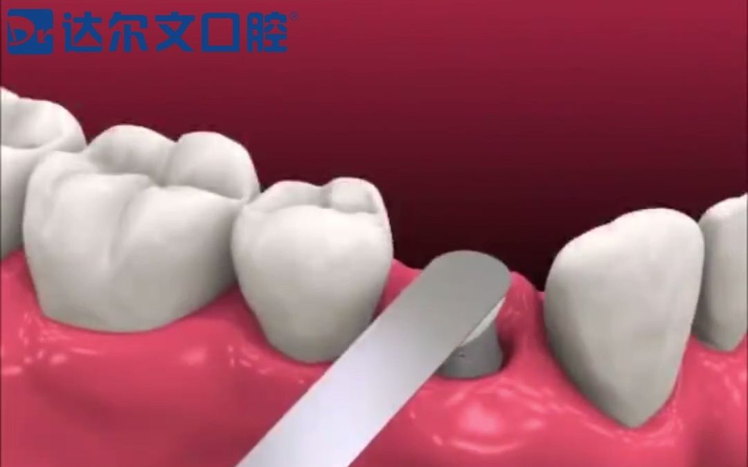 3D动画演示种植牙全过程