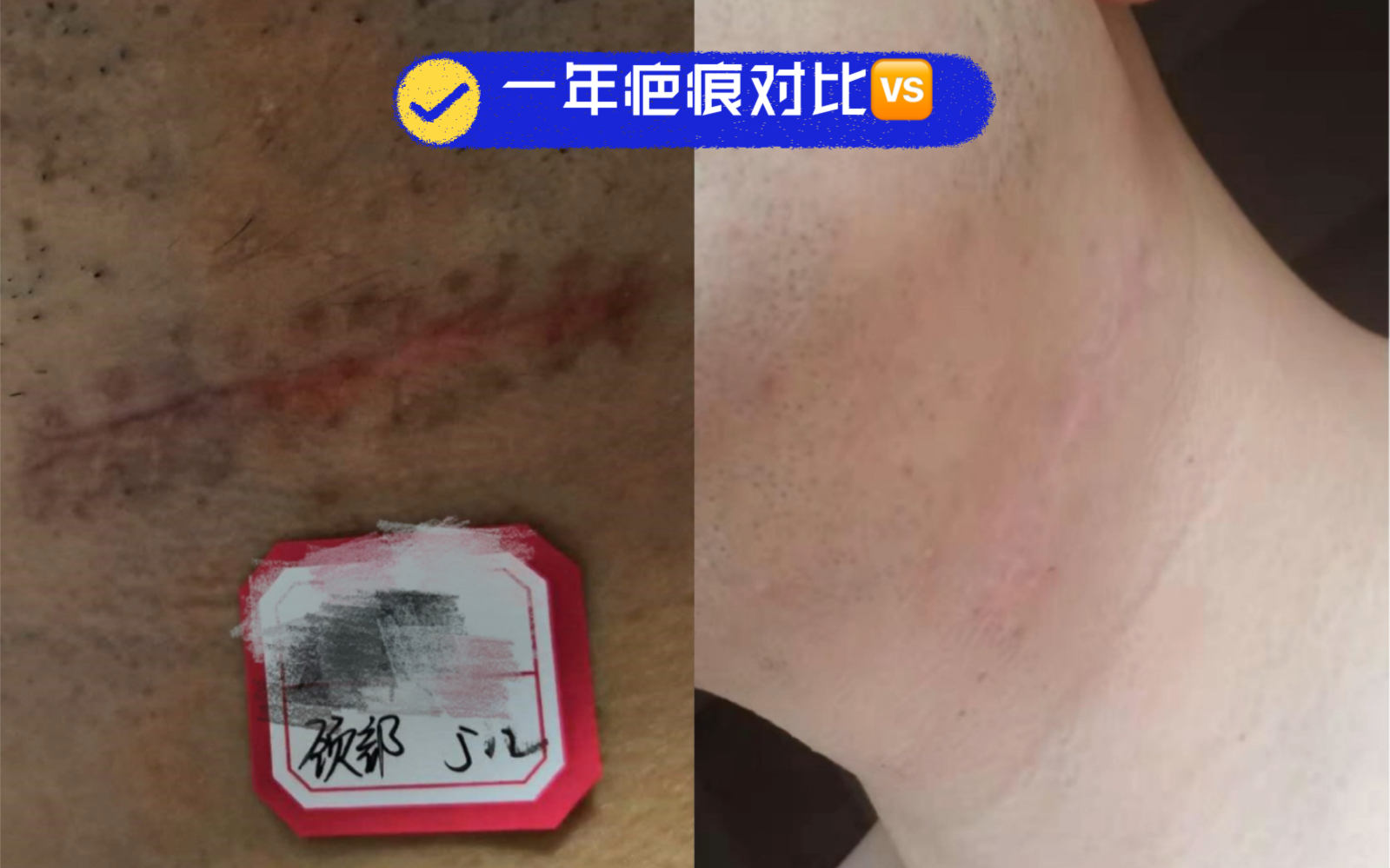 美容精细缝合一年疤痕对比,惊艳到了!