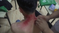 火龙罐颈肩部手法演示2