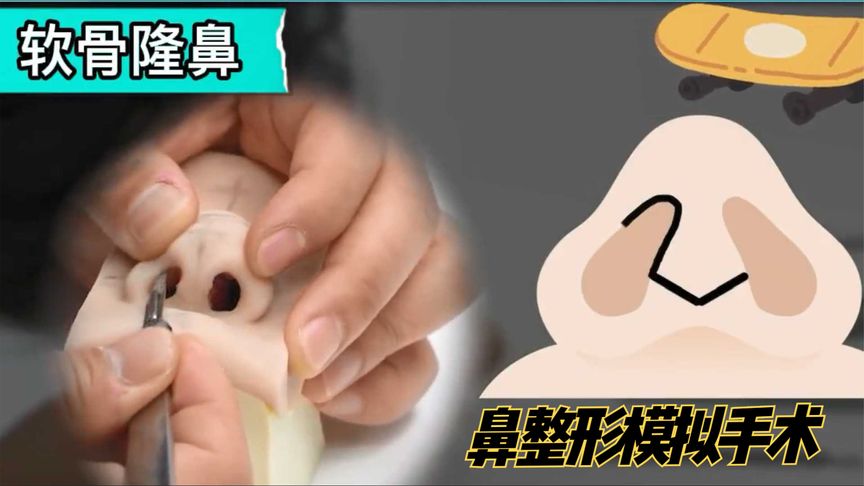 3D模拟隆鼻手术雕刻全过程,塌鼻梁变高鼻梁,效果好,看着疼!