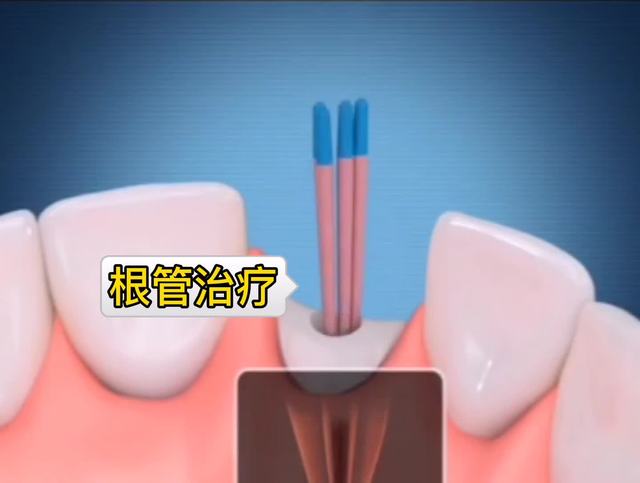 门牙打桩是怎么一回事呢?深圳根管治疗