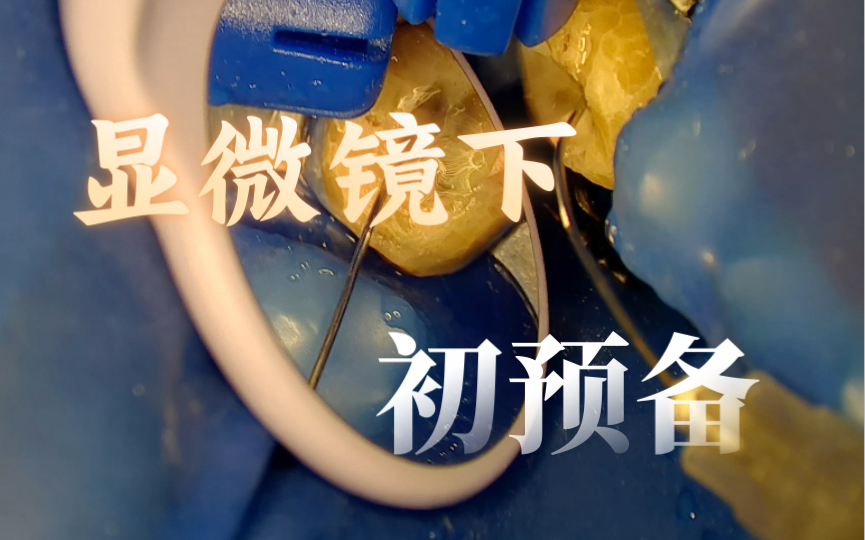显微镜下根管初预备。