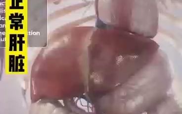 肝硬化是如何演变成肝癌的?