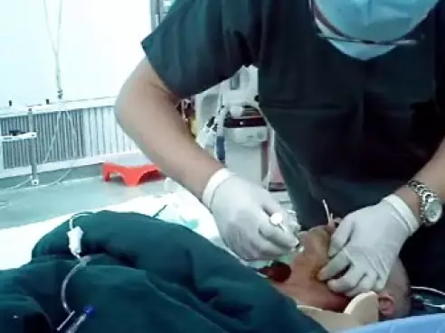 清醒表麻神经阻滞经鼻盲探气管内插管