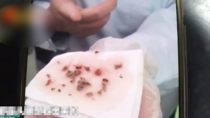 吓人!礼花变“炸弹”,男子眼睛被炸伤,取出大量鞭炮渣