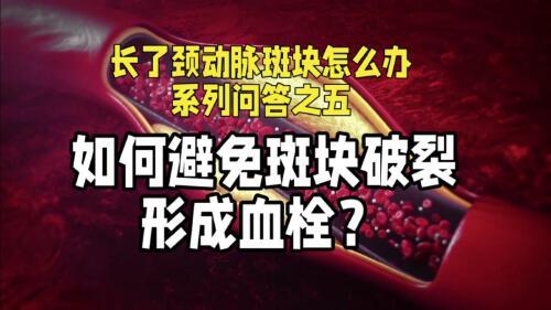 长了颈动脉斑块怎么办系列问答之五:如何避免斑块破裂形成血栓?