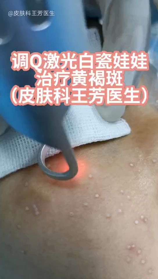 10.调Q激光白瓷娃娃治疗黄褐斑