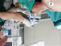 胸科手术麻醉中双腔气管的插管新方法(手机录像时倒过来了)
