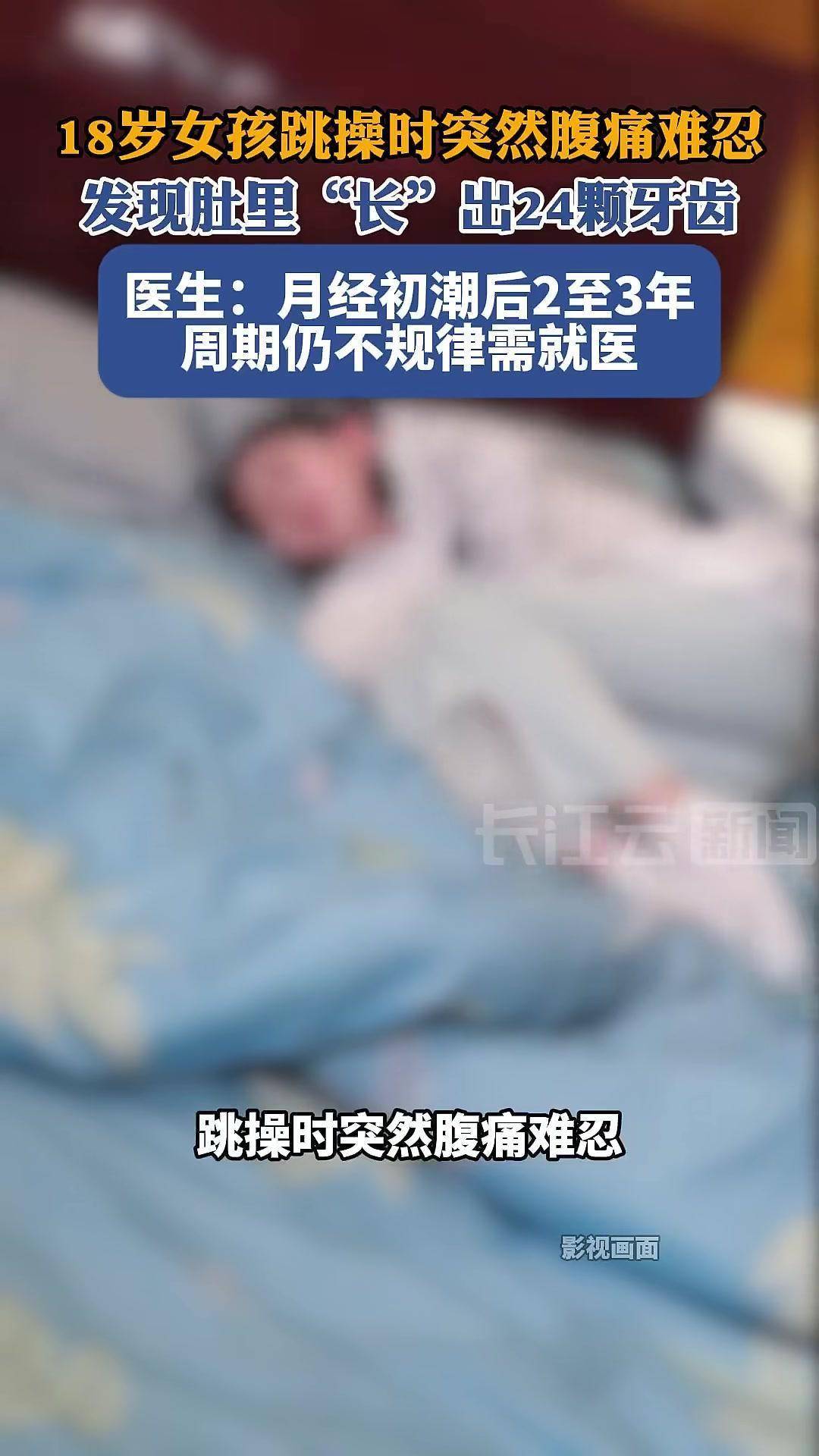 18岁少女跳操后腹痛不止,发现腹中巨大肿块,肿块中还有24颗牙齿